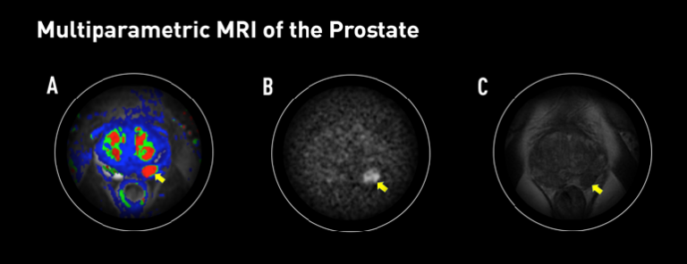 MRI Multiparamétrico (mpMRI) para el Cáncer de Próstata - San Cristóbal Cancer Institute